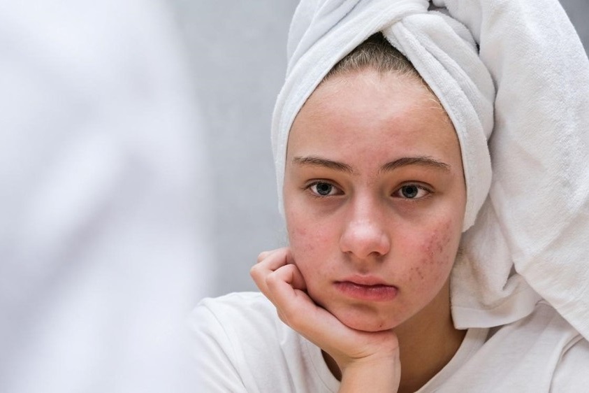 Aknebehandlung und sexuelle Gesundheit: Wie hängen sie zusammen? | DERMIDA